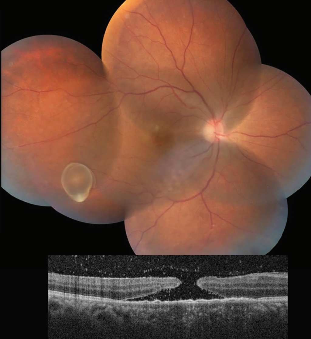 Intravitreal Cysticercosis With Full Thickness Macular Hole - Retina Today