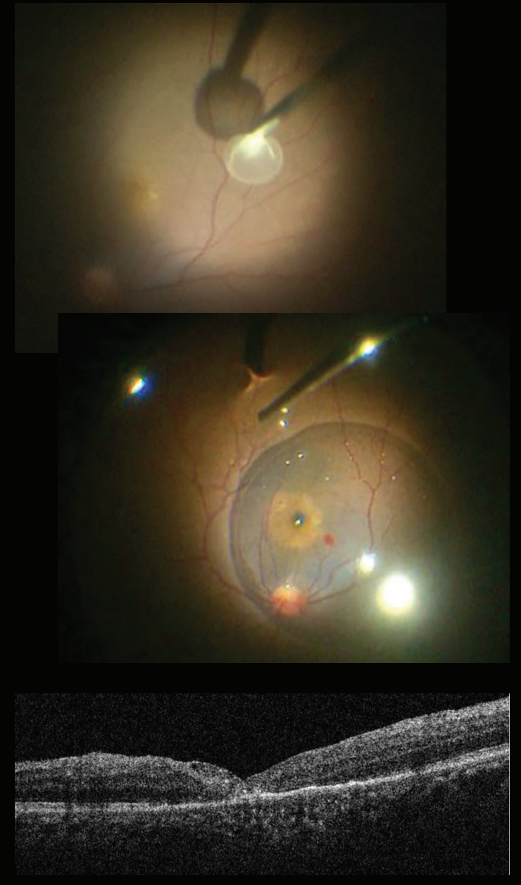 Intravitreal Cysticercosis With Full Thickness Macular Hole - Retina Today