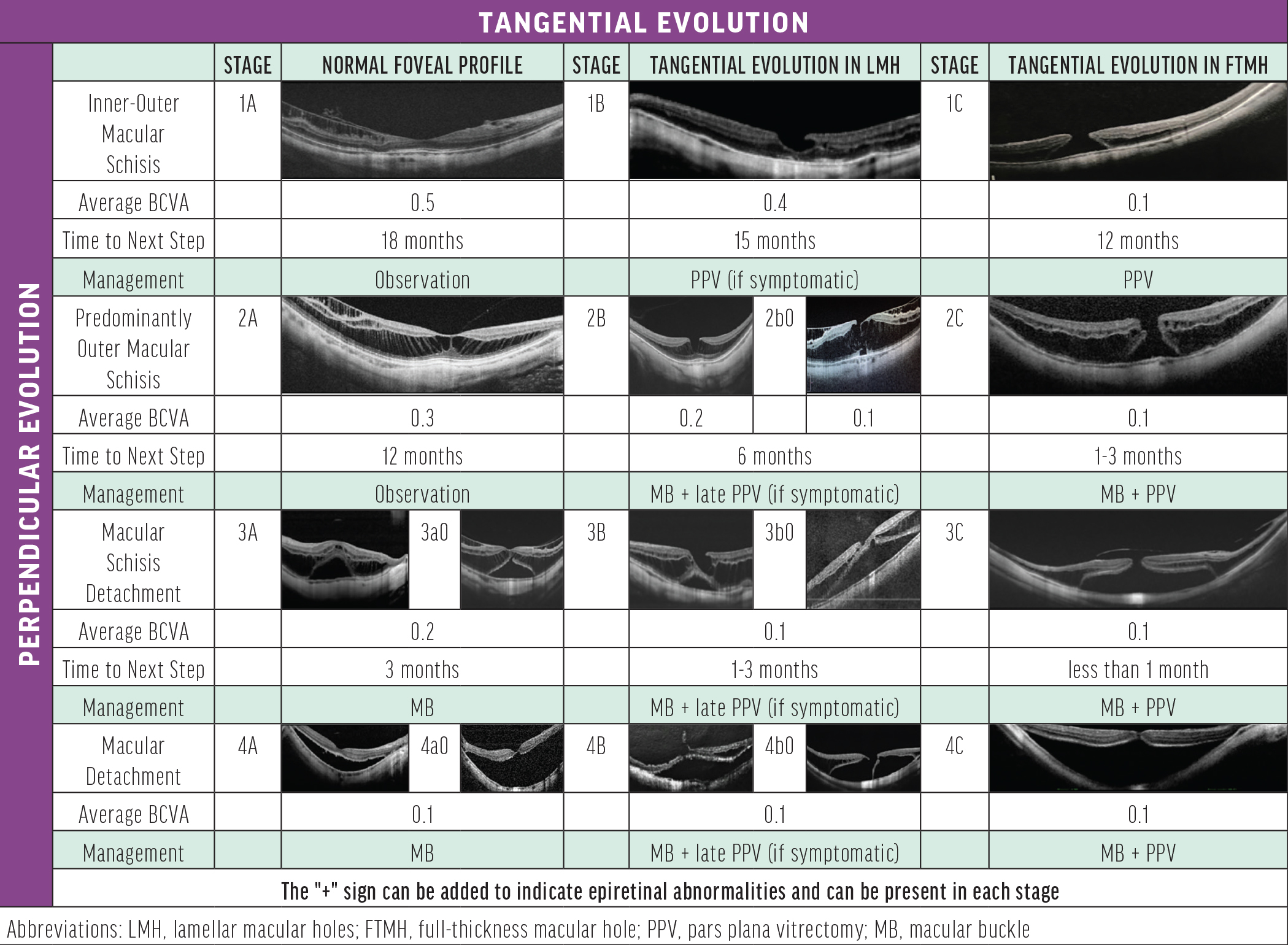 Macular Hole Macular Hole