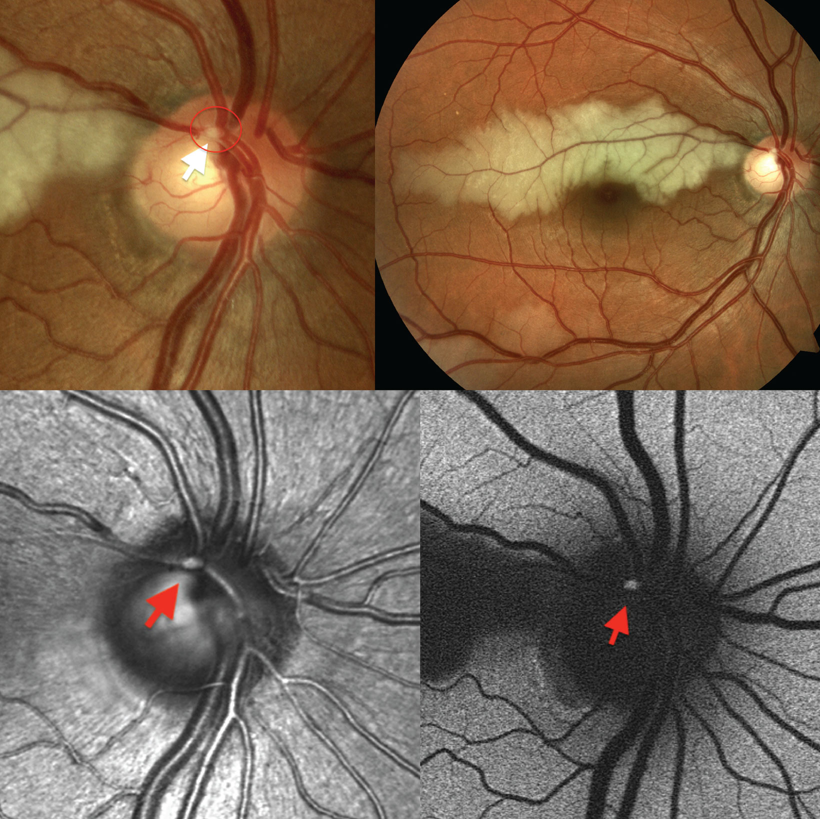Central Retinal Artery Occlusion Anatomy