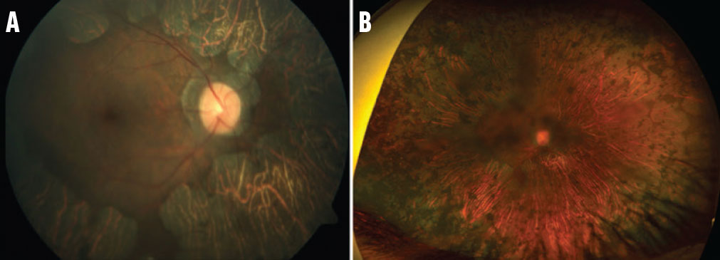 Today's Imaging Approaches for IRD - Retina Today