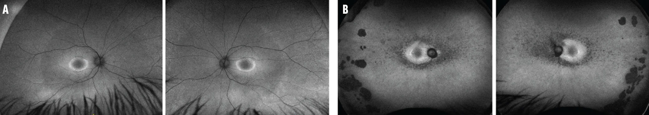 Today's Imaging Approaches for IRD - Retina Today