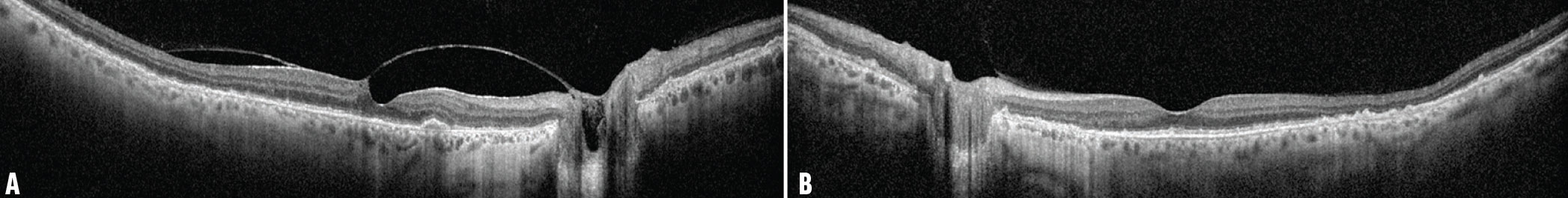Test Your Diagnostic Acumen: IRD Mystery Cases - Retina Today