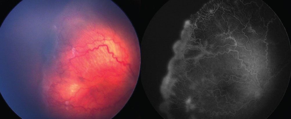 Imaging Tips and Tricks For Retinopathy of Prematurity - Retina Today