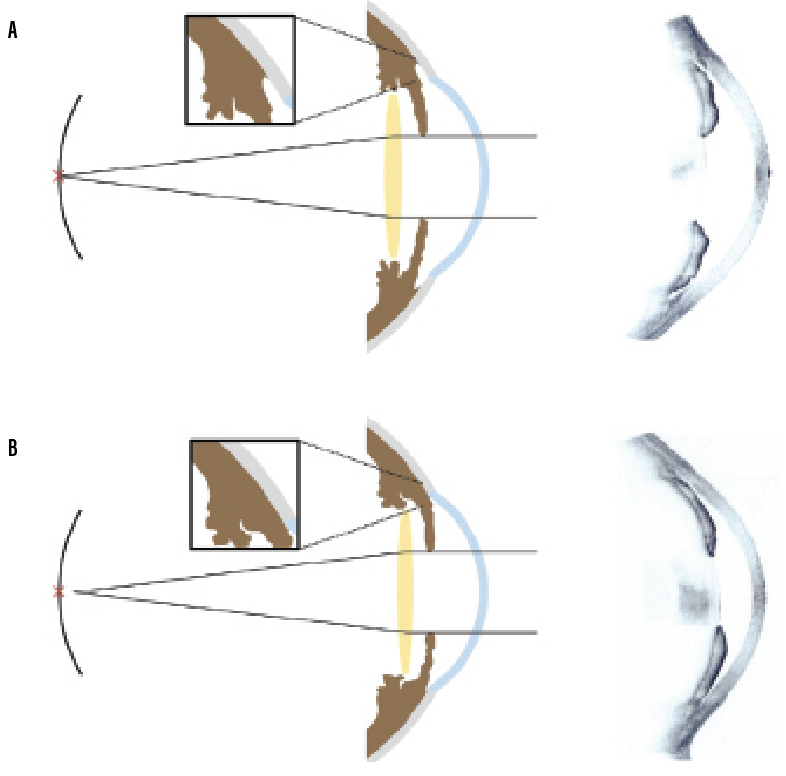 Refractive Outcomes in Patients With Primary Angle-Closure Glaucoma ...