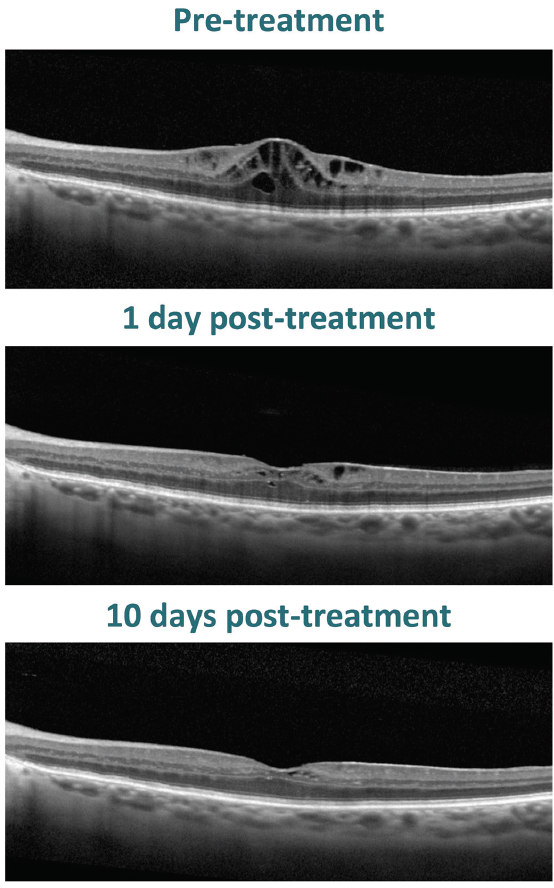 Sustained-Release Steroid Options For DME Therapy - Retina Today