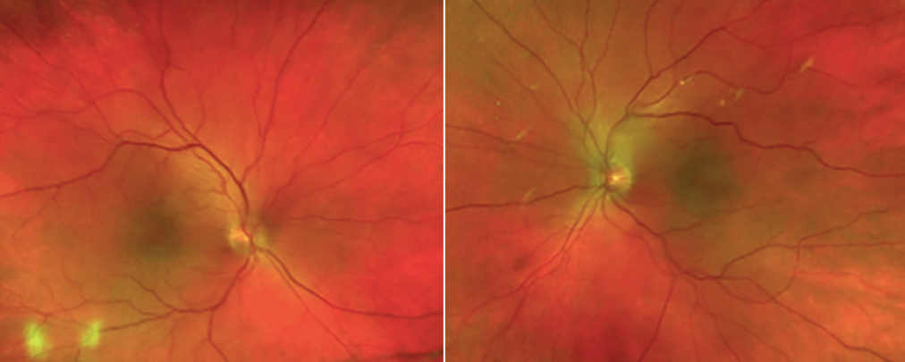 Cystoid Macular Edema With an Oncology Twist - Retina Today