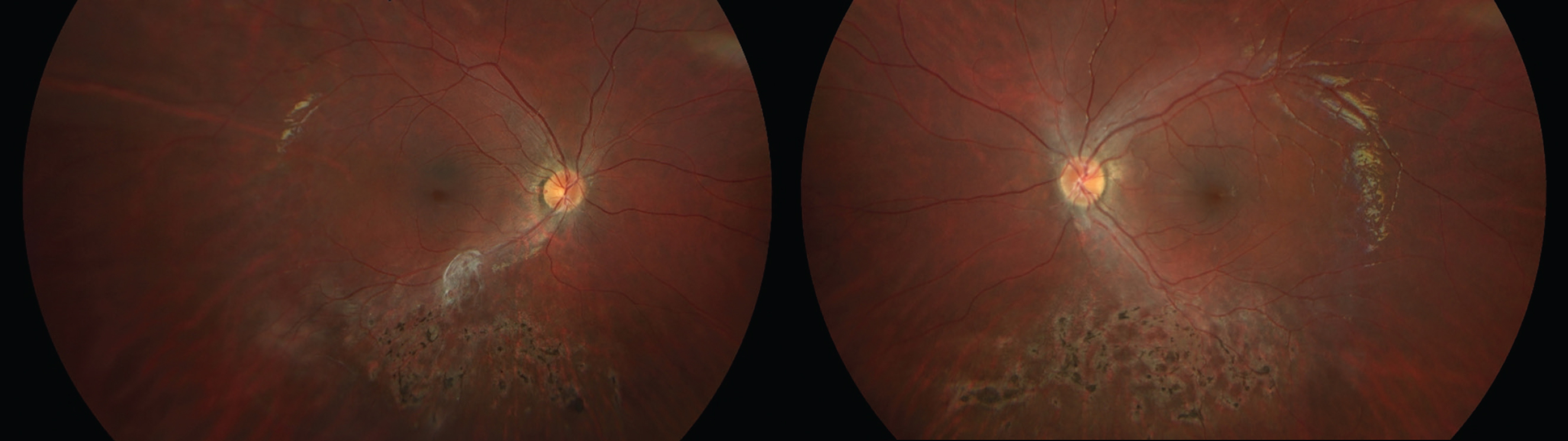 An Unusual Case of Pigmentary Retinopathy - Retina Today