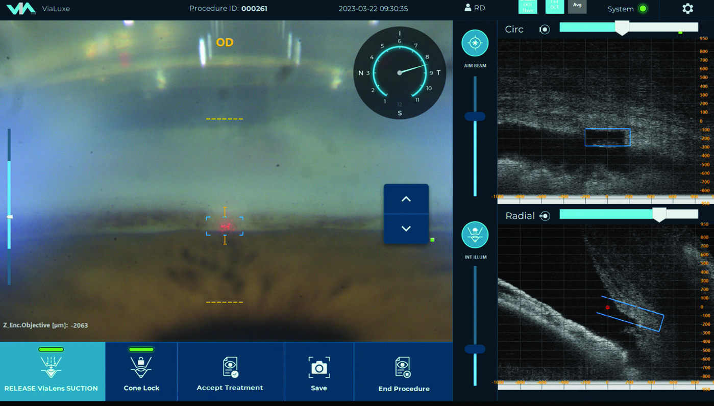 The Evolution of the Femtosecond Laser and Its Role in Glaucoma ...