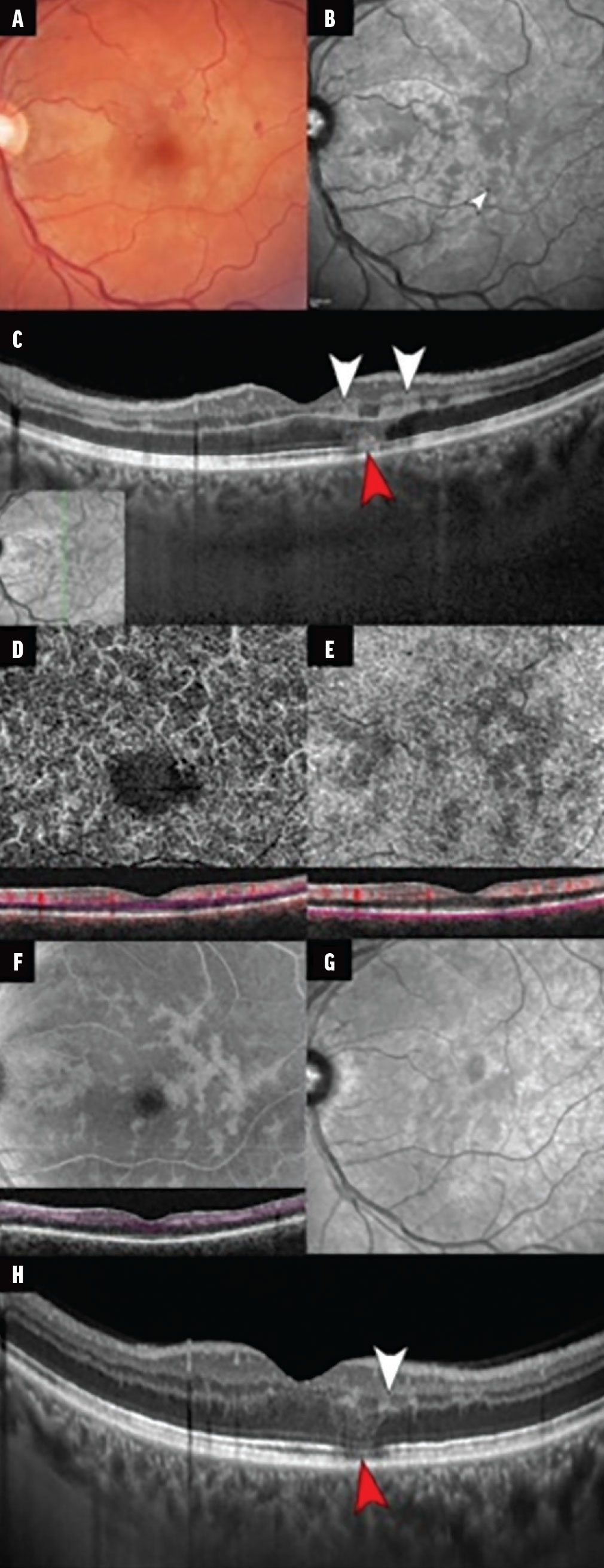 Coincident PAMM And AMN: Finding the Missing Link - Retina Today