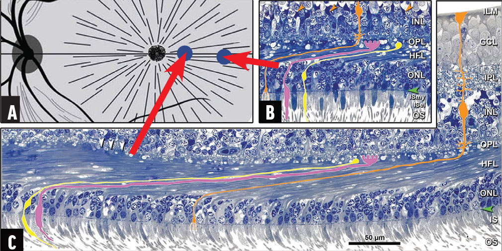 Coincident PAMM And AMN: Finding the Missing Link - Retina Today
