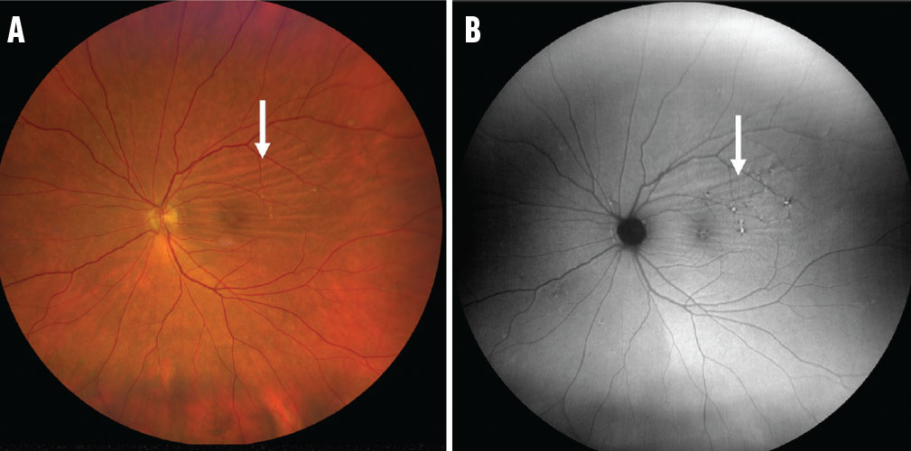 Uncovering the Truth Behind Choroidal Folds - Retina Today