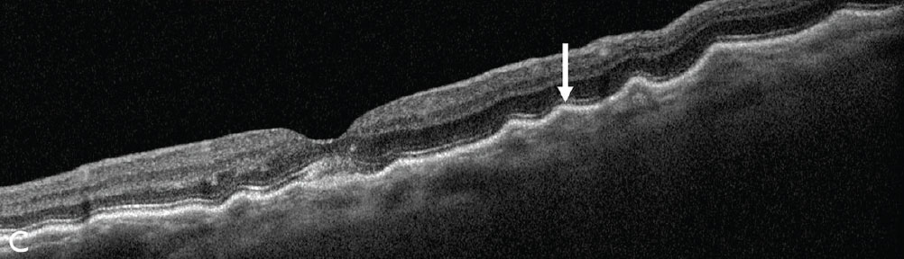Uncovering the Truth Behind Choroidal Folds - Retina Today