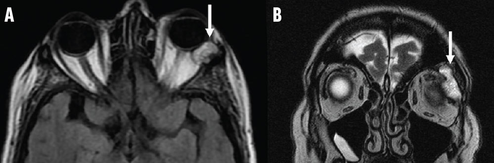 Uncovering the Truth Behind Choroidal Folds - Retina Today