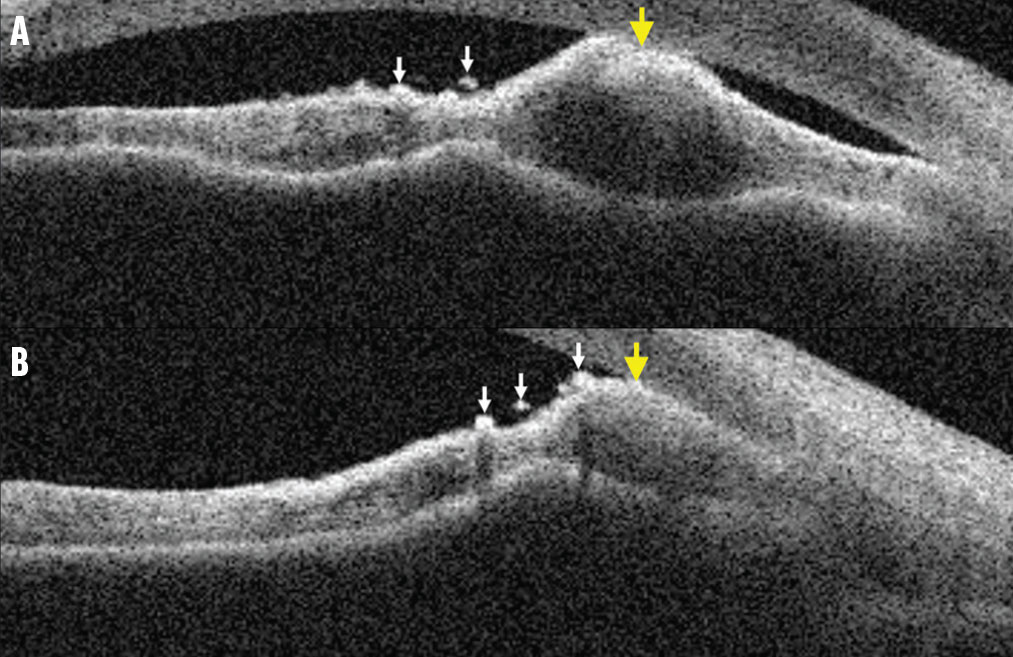 Cogan-Reese Syndrome: an Iris Melanoma Masquerader - Retina Today