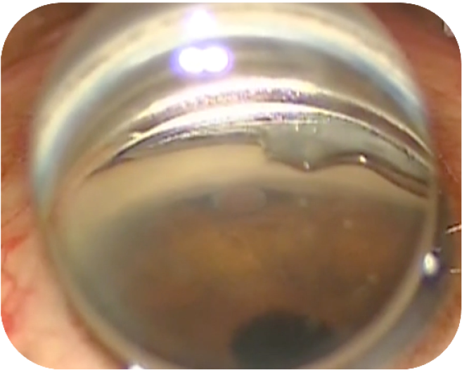 Miniject: Harnessing the Drainage Power of the Supraciliary Space ...