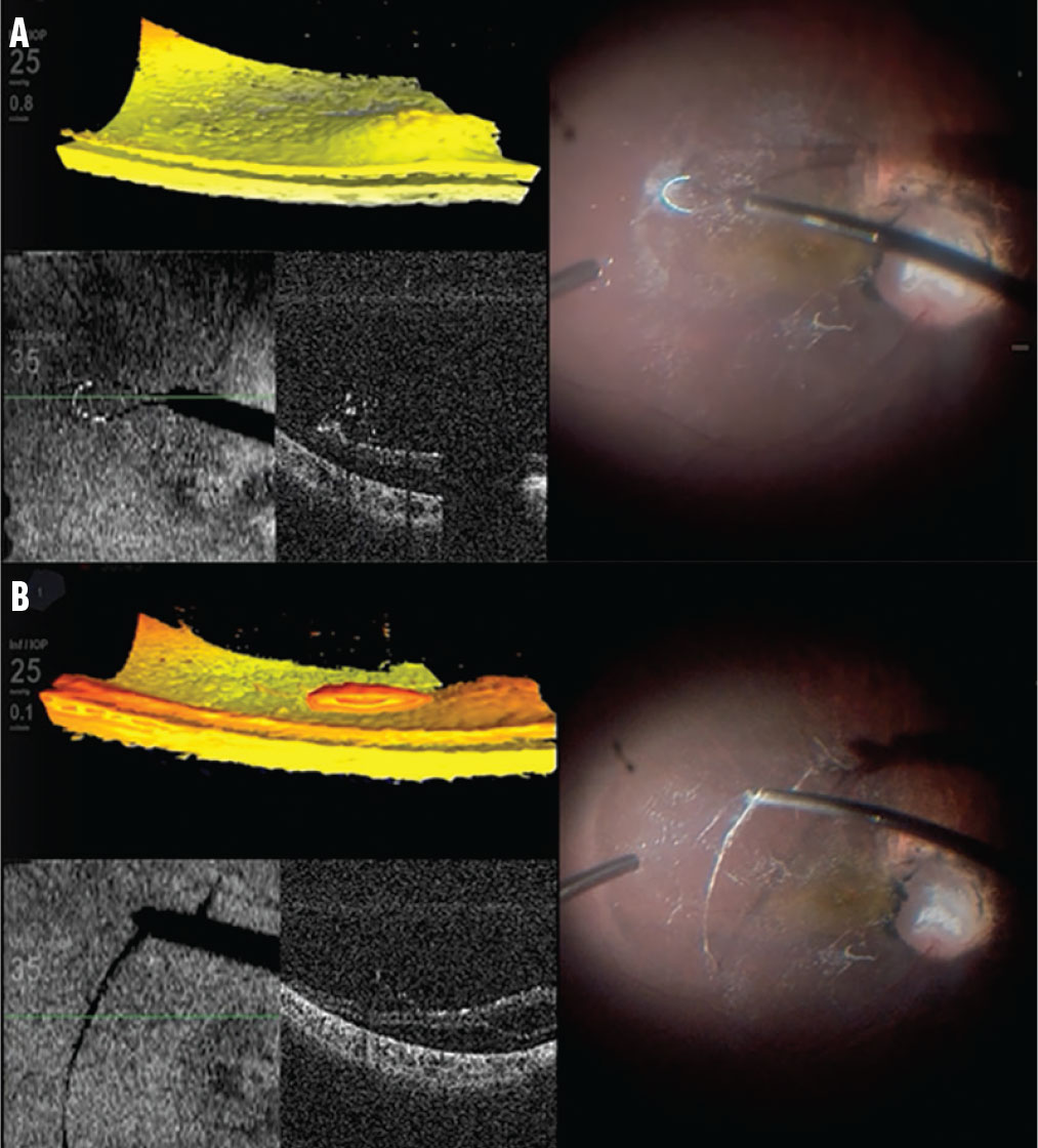 Pediatric Vitreoretinal Surgery Tips - Retina Today