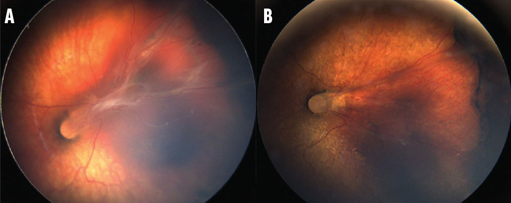 Pediatric Vitreoretinal Surgery Tips - Retina Today