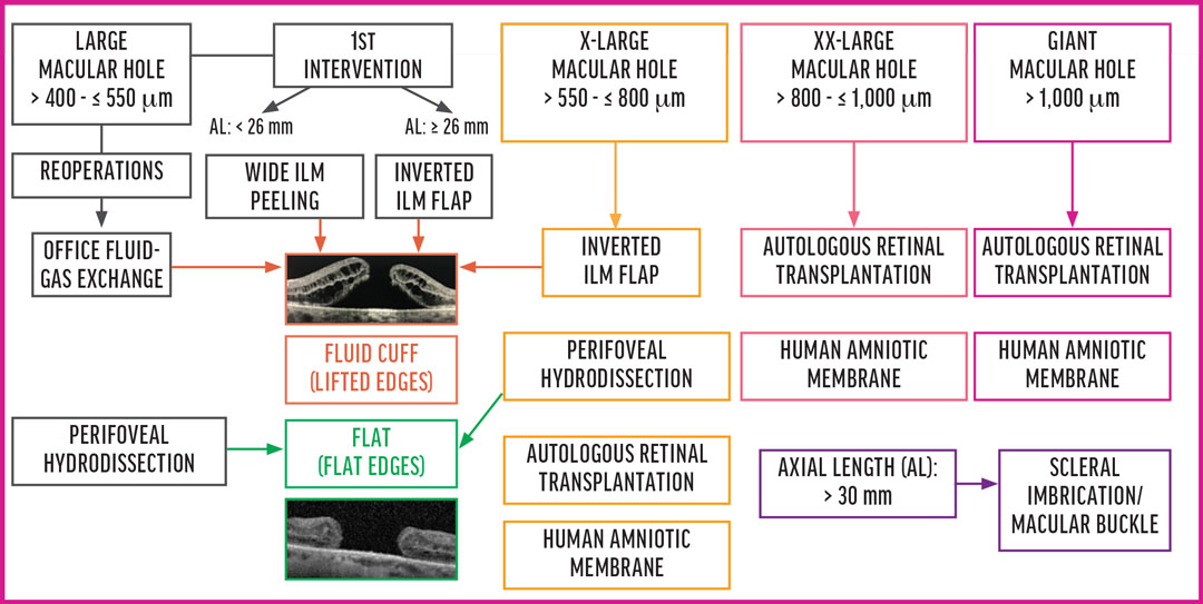 Macular Hole Closure: A New Classification - Retina Today