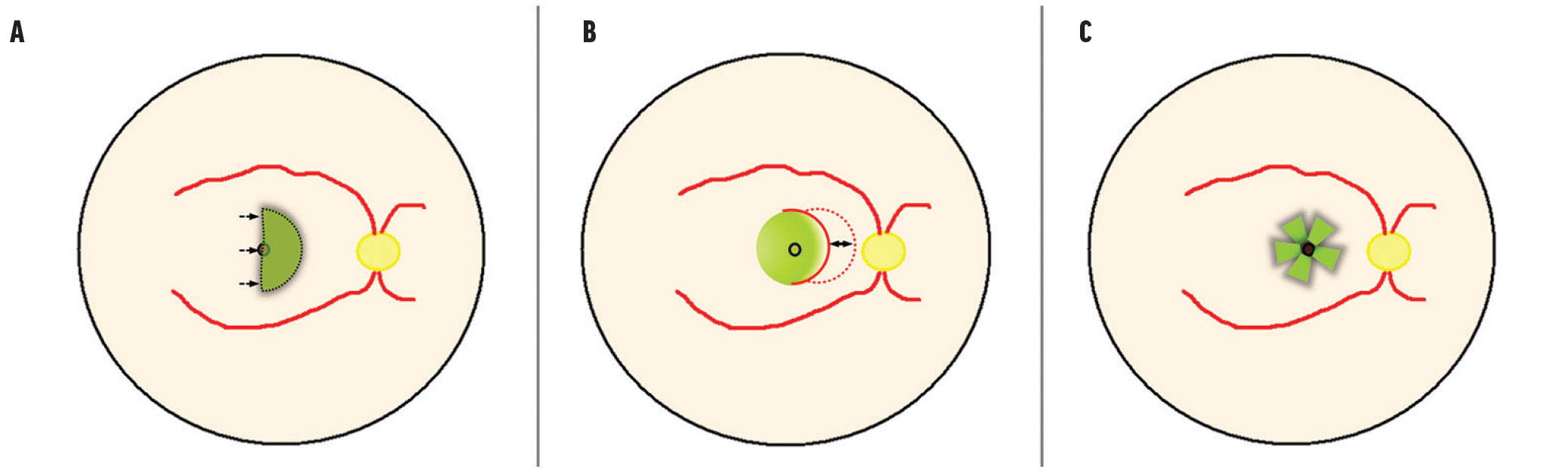 The Modern Management of Challenging Macular Holes - Retina Today