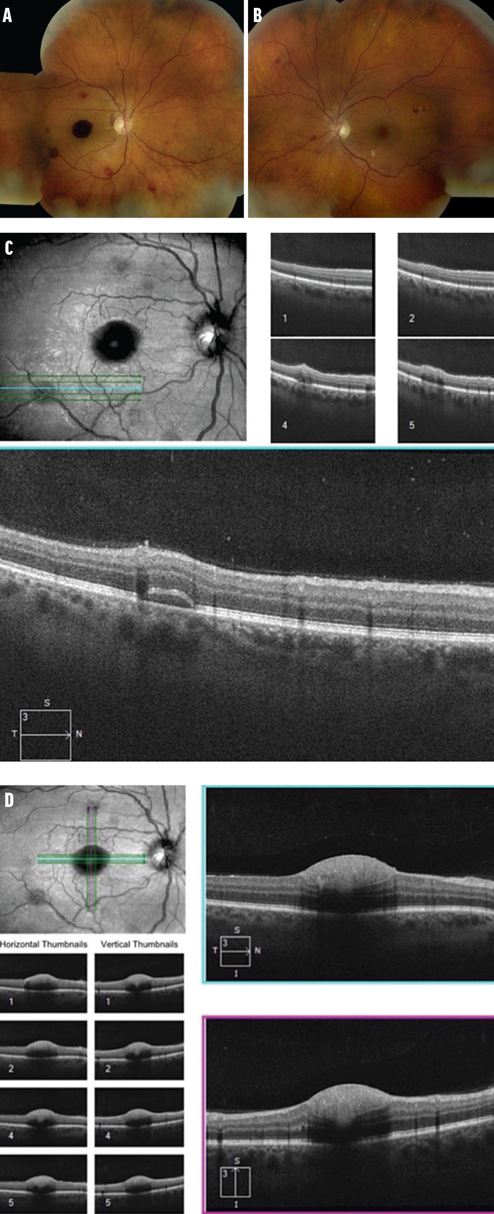 Infective Endocarditis Detected in Retinal Examination - Retina Today