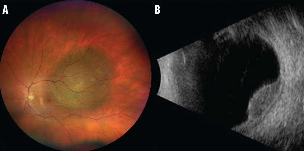 Tissue Glue-Assisted Plaque Radiotherapy for Uveal Melanoma - Retina Today