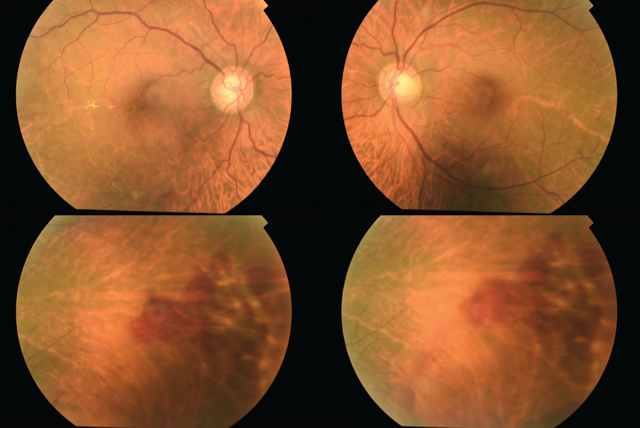 Bullet Proof: A Case of Chorioretinitis Sclopetaria - Retina Today
