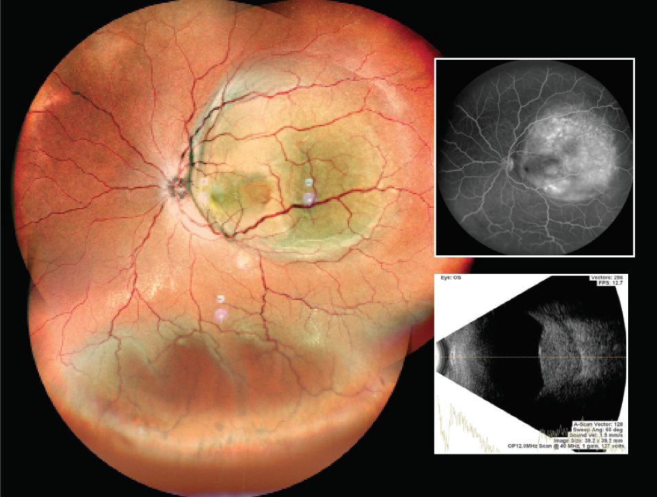 Choroidal Mass: Wading Through the Differentials - Retina Today