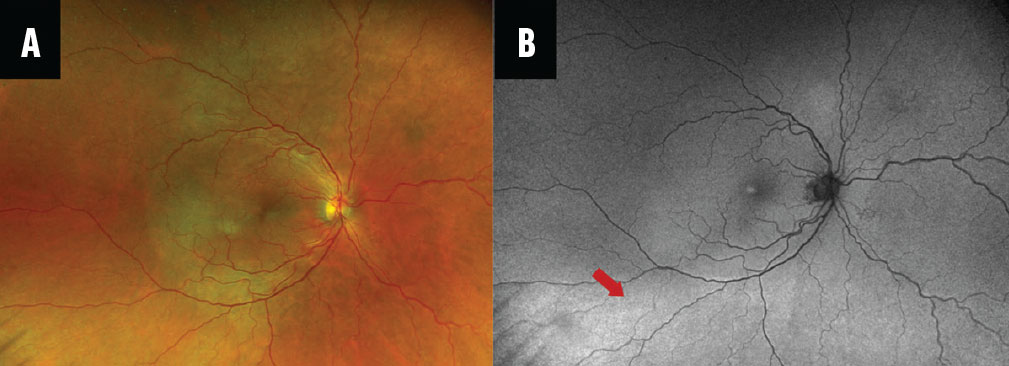 Retinal Biomarkers of Systemic Disease: Part Two - Retina Today Retinal Biomarkers of Systemic Disease: Part Two - Retina Today