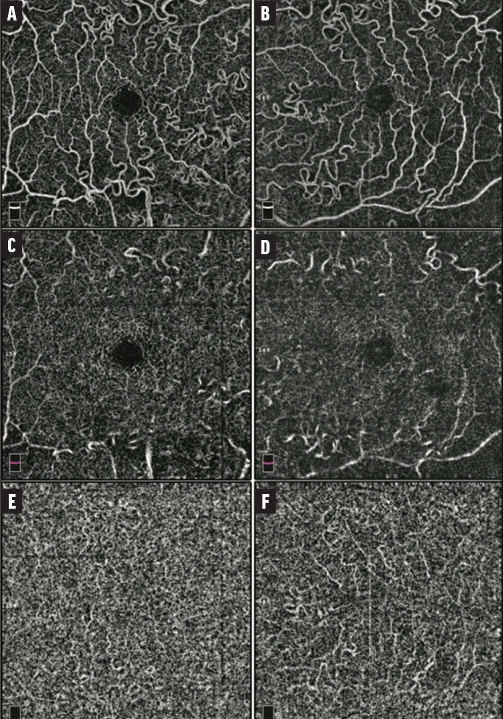 Retinal Biomarkers of Systemic Disease: Part Two - Retina Today Retinal Biomarkers of Systemic Disease: Part Two - Retina Today