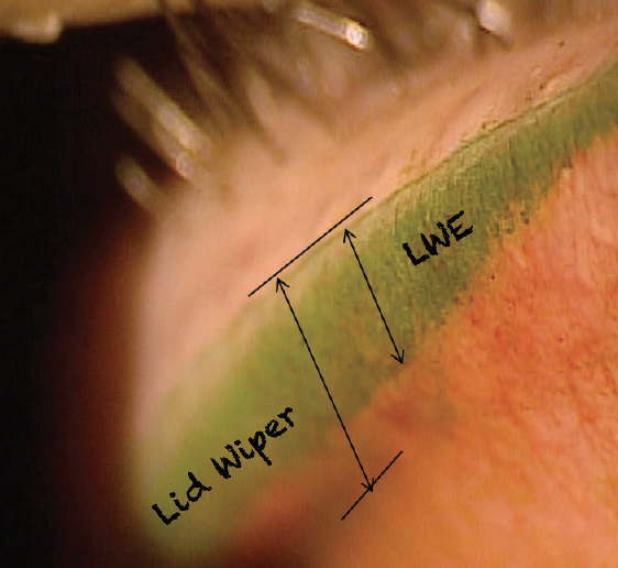 Taking Dry Eye Care to the Next Level - Modern Optometry