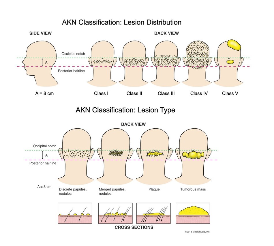 New AKN Classification System May Improve Treatment - Practical Dermatology