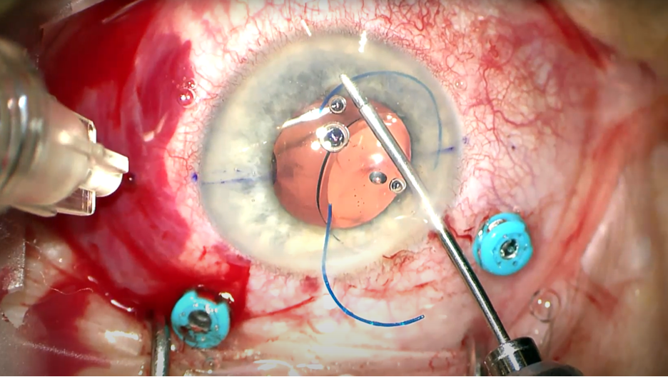 IOL Options for Sutureless Fixation - Retina Today