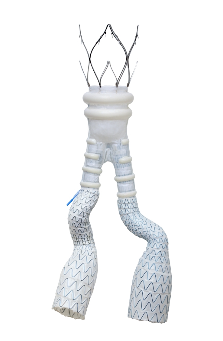 Endologix Alto Abdominal Stent Graft System Introduced in Canada and ...