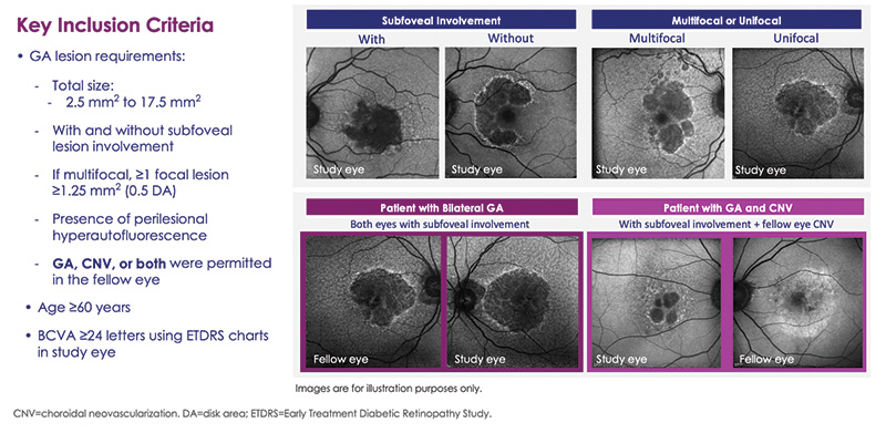 The Potential of SYFOVRE for Slowing the Progression of Geographic ...