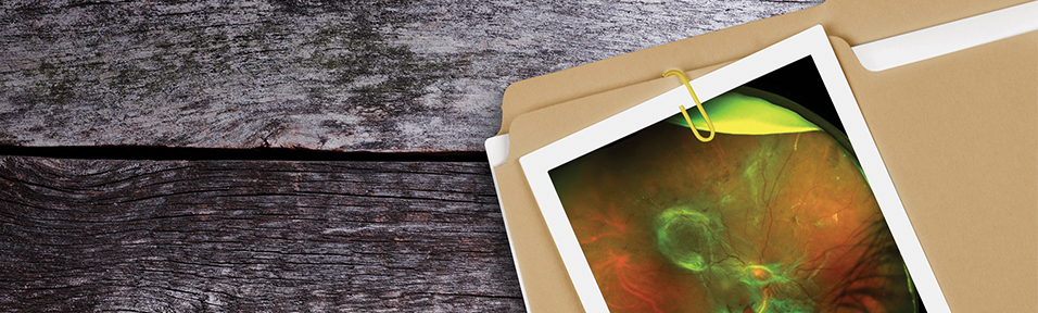 Subretinal Tissue Plasminogen Activator (tPA) for the Treatment of ...