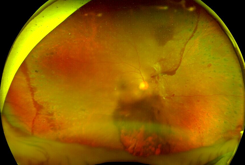 Diabetic Vitreous Hemorrhage: Inject or Operate? - Retina Today