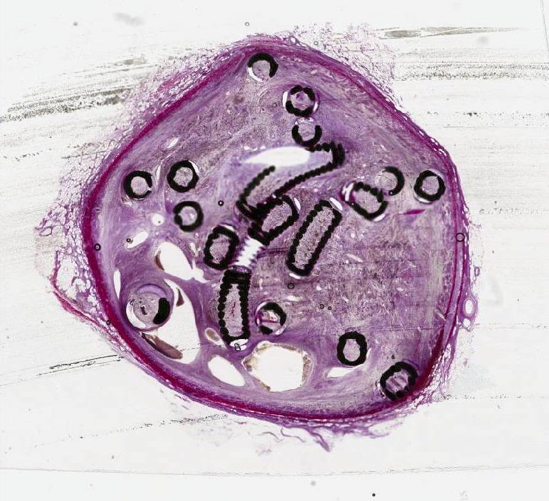Cook Medical’s Nester Fibered Coils Evaluated for Venous Use in Animal ...