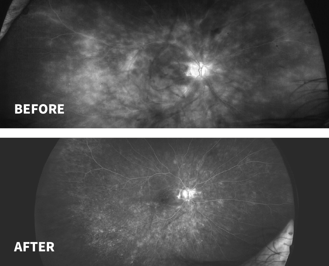 Chronic Birdshot Chorioretinopathy OU - Retina Today