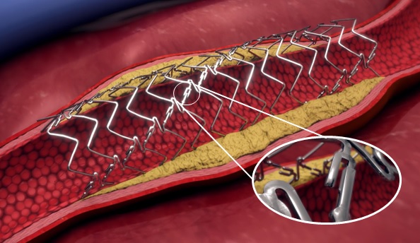 Elixir’s DynamX Bioadaptor System Granted FDA Breakthrough Device ...