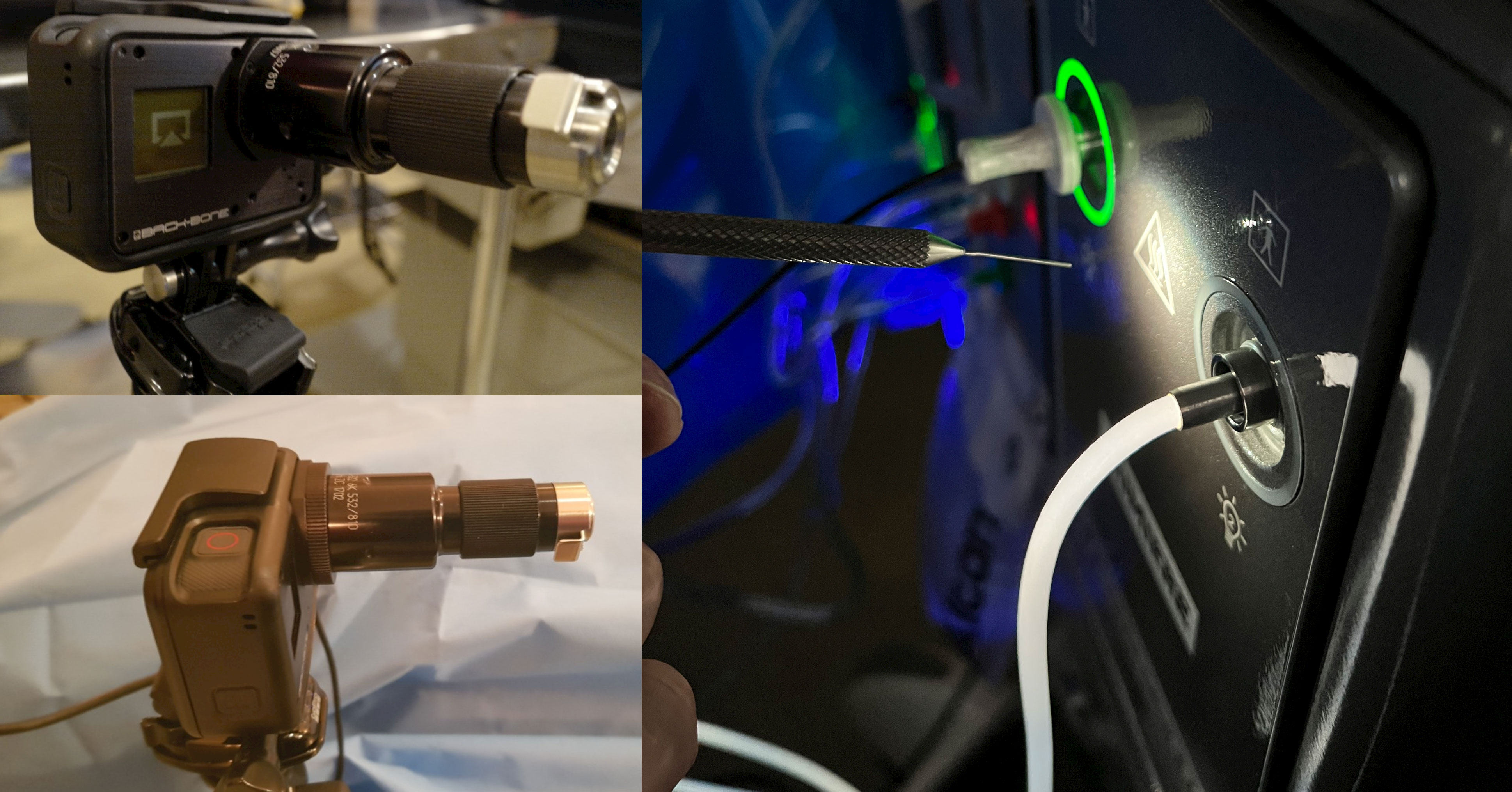 Endoscopy-Assisted Vitrectomy: Tips to Improve the View - Retina Today