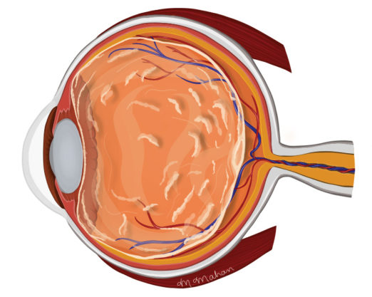 Best Practices on Referring Patients With Symptomatic Vitreous ...