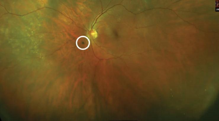 Best Practices on Referring Patients With Symptomatic Vitreous ...