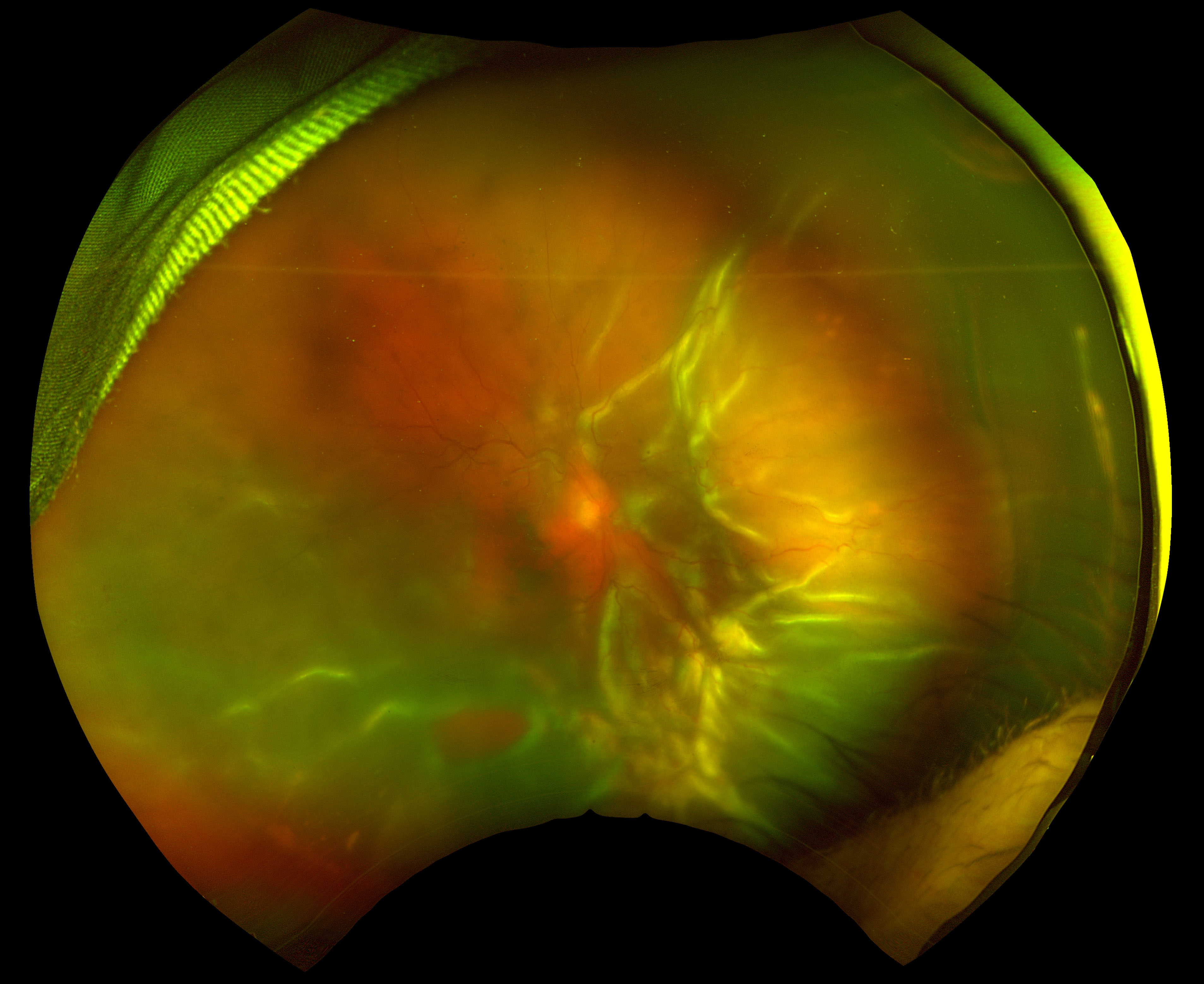 Retinal Detachment Surgery in the Aging Eye - Retina Today