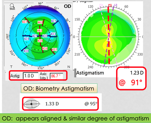 Collaborative Case #010: Managing the Unhappy Presbyopic IOL Patient ...