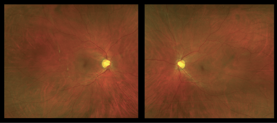 Glaucoma or Long COVID - Glaucoma Today