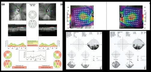 Screening and Establishing a Diagnosis With OCT - Glaucoma Today