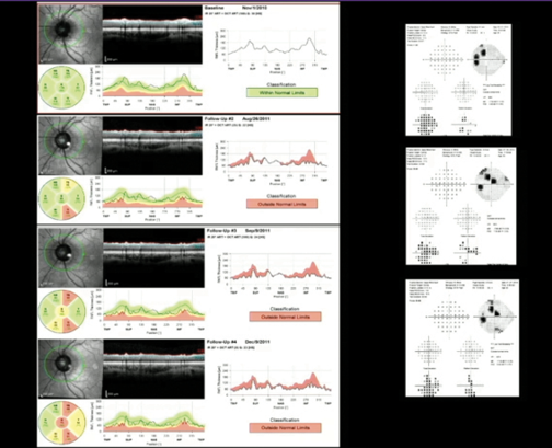 Screening and Establishing a Diagnosis With OCT - Glaucoma Today