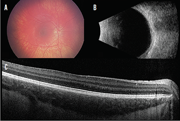 Fovea Plana in a 6-Month-Old Infant - Retina Today