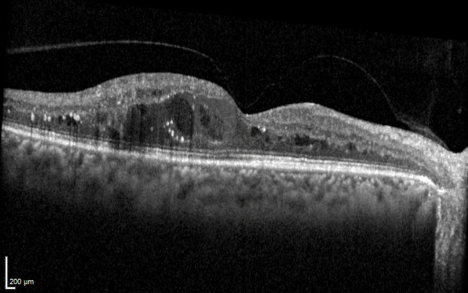 Diabetic Eye Disease: The Therapeutic Landscape - Retina Today